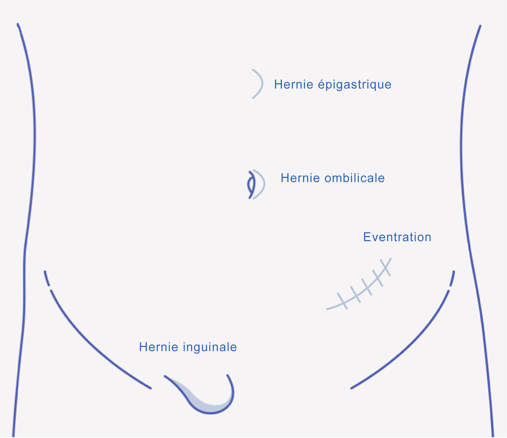 Chirurgie pariétale - CHC MontLégia